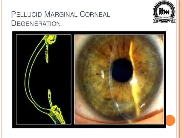 Corneal degeneration ppt
