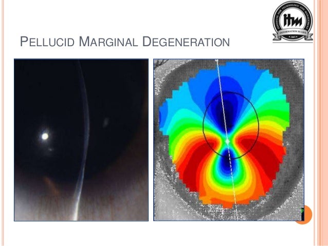 Corneal degeneration ppt