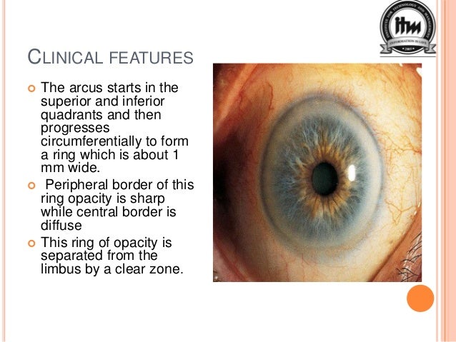 Corneal degeneration ppt