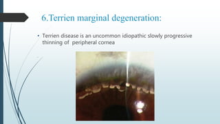 Corneal degeneration | PPTX