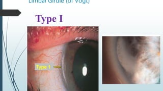 Limbal Girdle Of Vogt