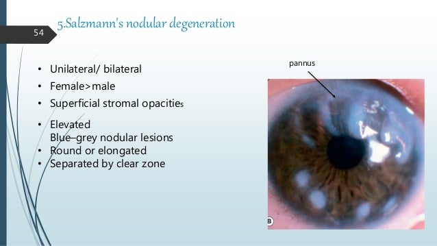Corneal degeneration