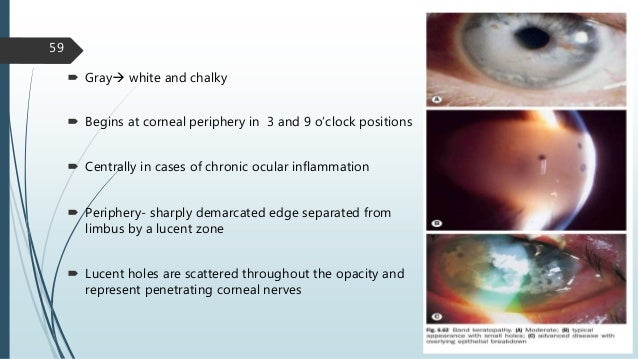 Corneal degeneration