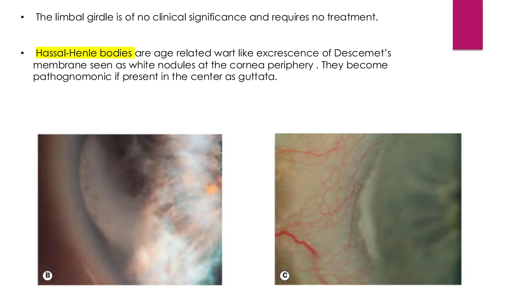 corneal degenerations including pallucid | PDF