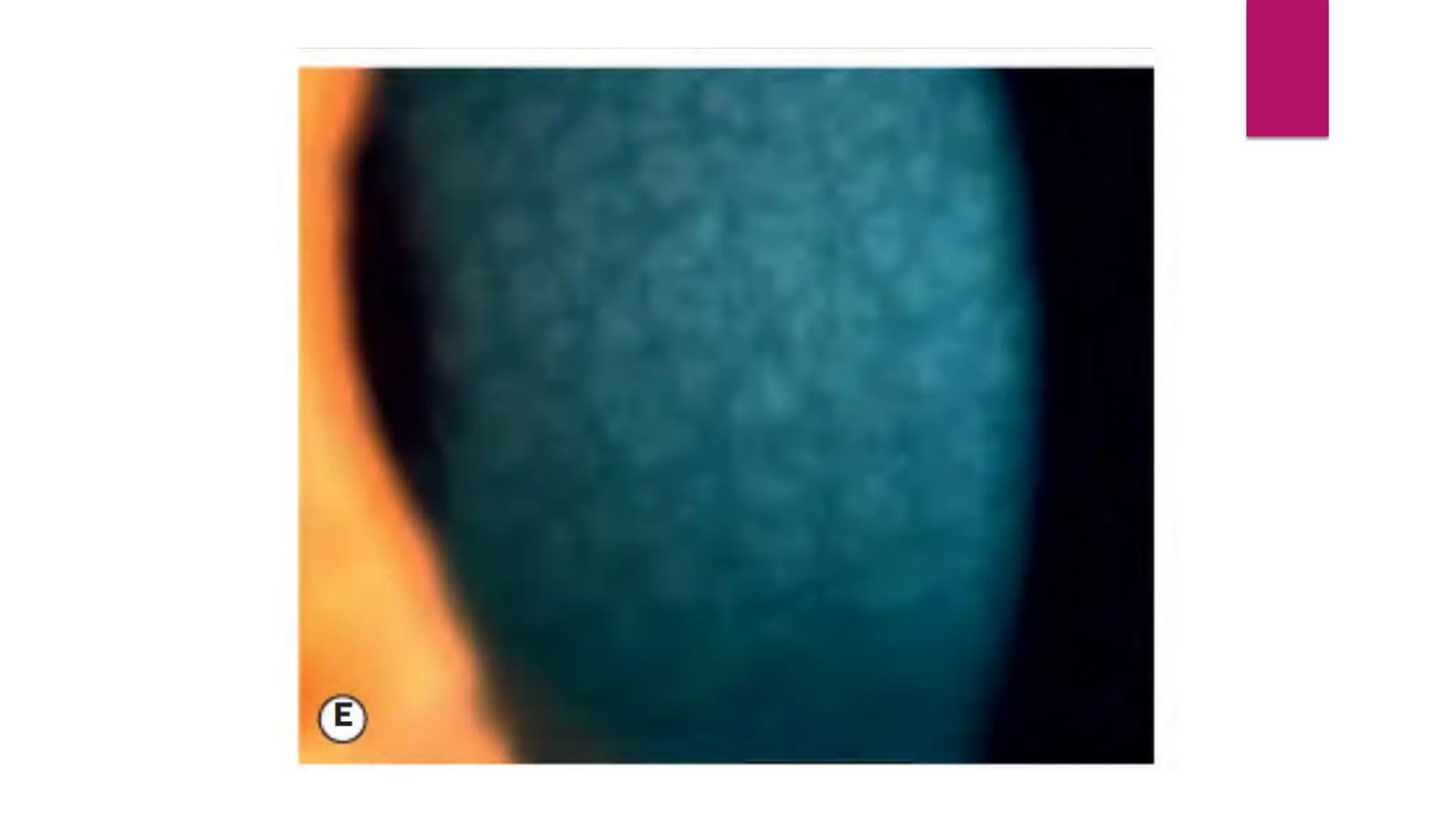corneal degenerations including pallucid | PDF