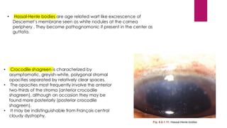 corneal degenerations including pallucid | PDF