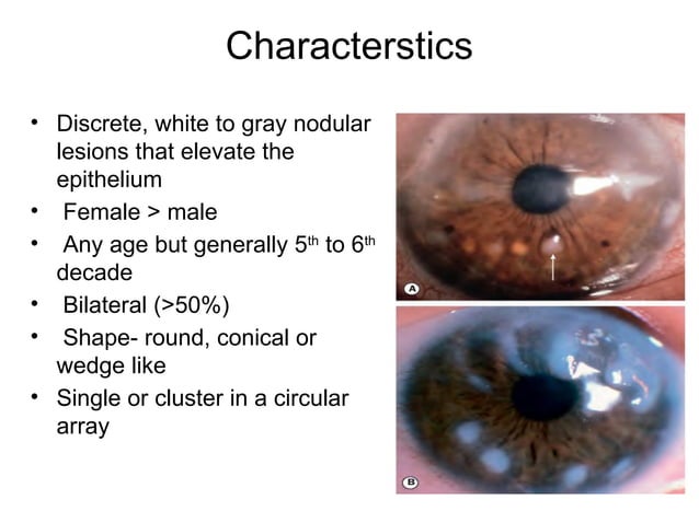 CORNEAL DEGENERATIONS types by Dr supratim.pptx