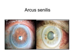 CORNEAL DEGENERATIONS types by Dr supratim.pptx