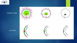 corneal diagrams and colour codes | PPTX