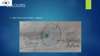 corneal diagrams and colour codes | PPTX