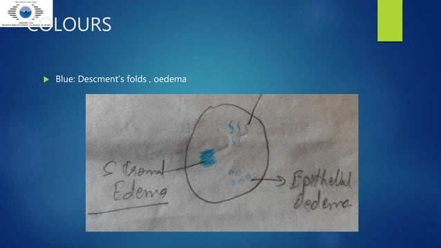 corneal diagrams and colour codes | PPTX
