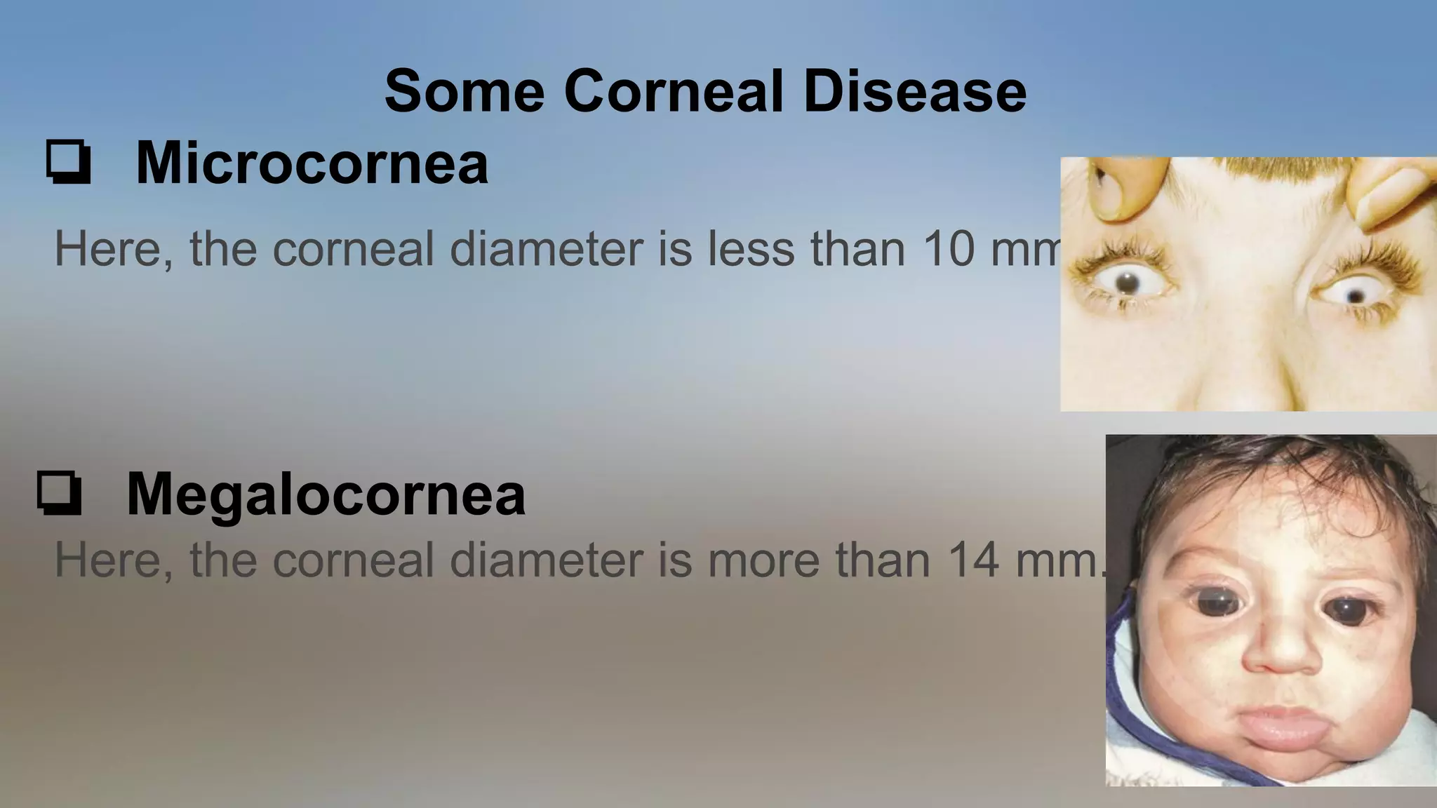 Corneal Disease by Saharukh | PDF