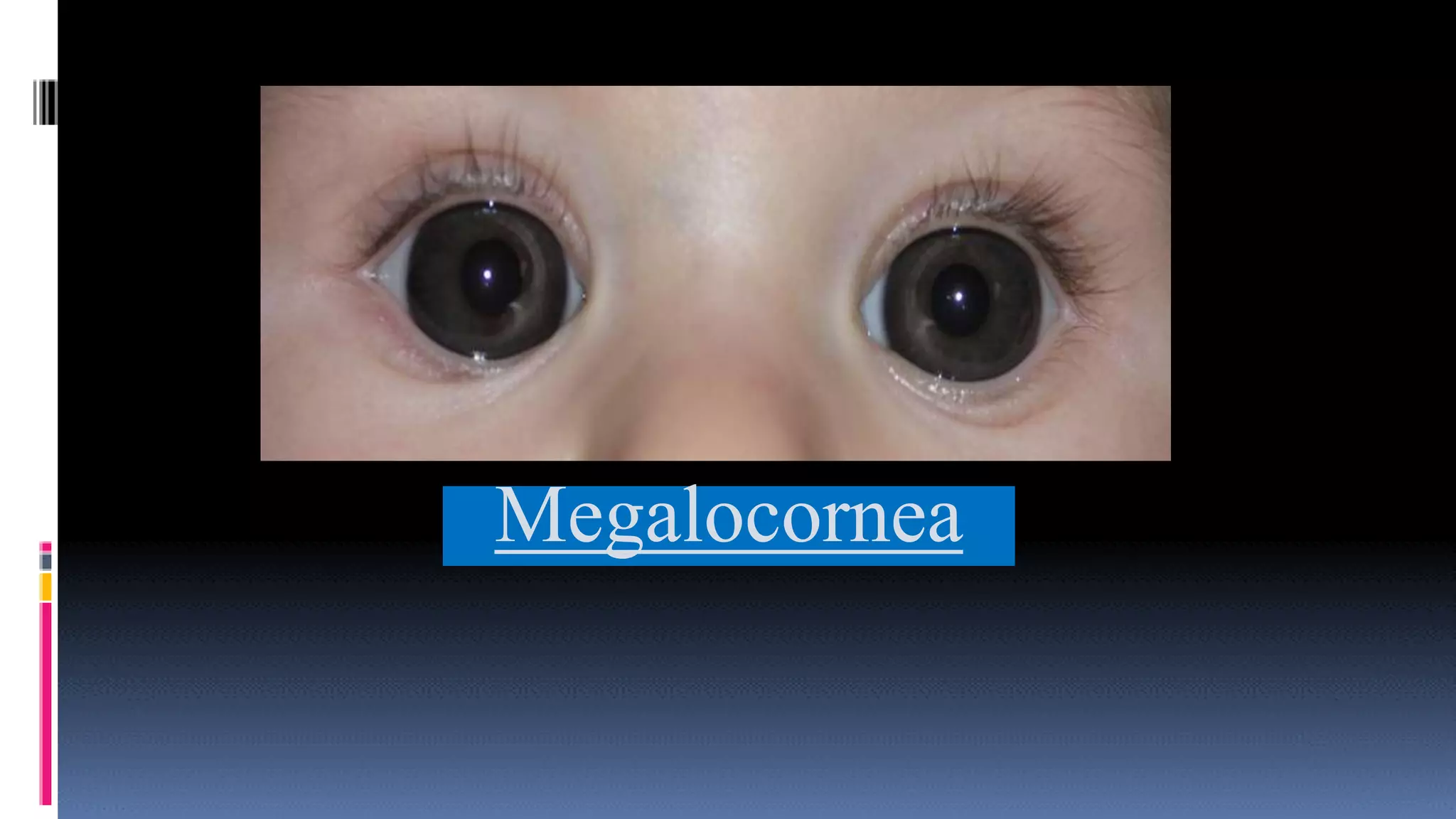 Corneal diseases | PPTX