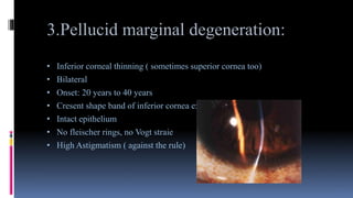 Corneal diseases | PPTX