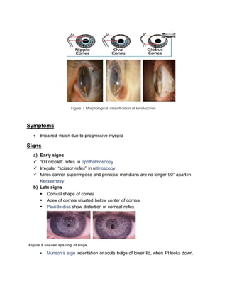 Corneal Diseases.docx