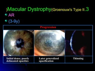 Macular Dystrophy Corneal