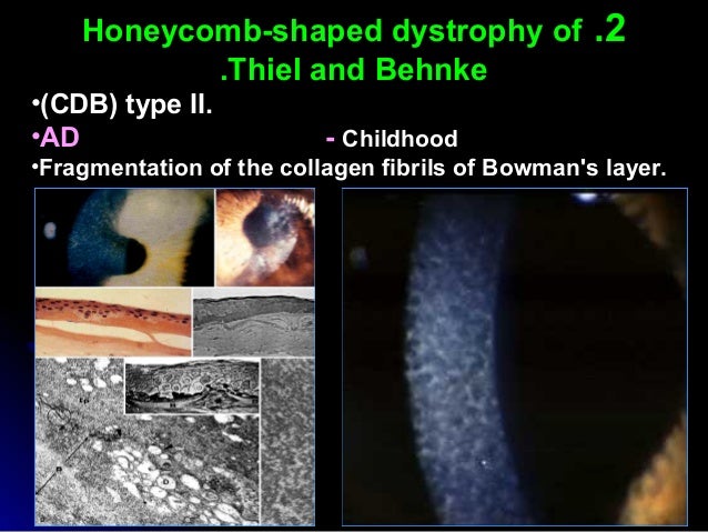 Thiel Behnke Corneal Dystrophy Cornea Grand Rounds