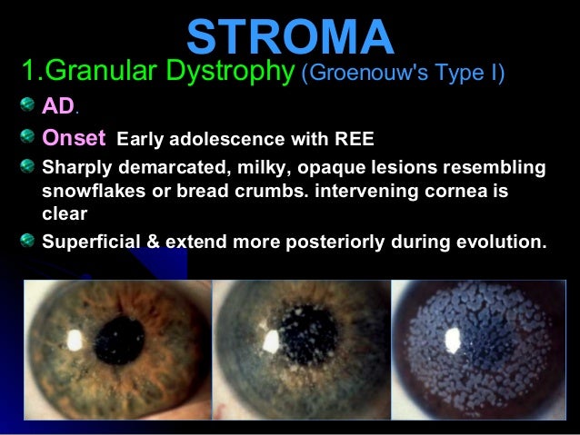 Corneal dystrophies by Dr. Safaa Refaat