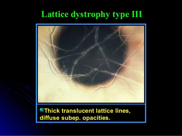 Corneal dystrophies by Dr. Safaa Refaat