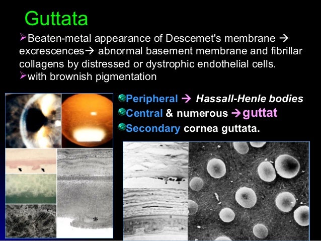 Corneal dystrophies by Dr. Safaa Refaat