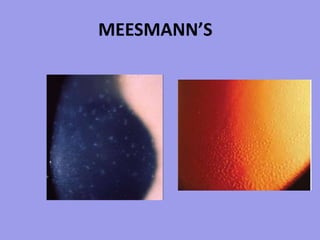 Meesmann Corneal Dystrophy