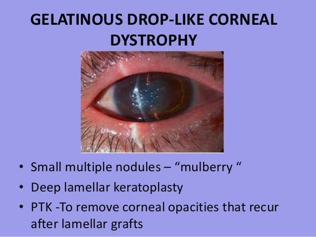 Corneal dystrophies