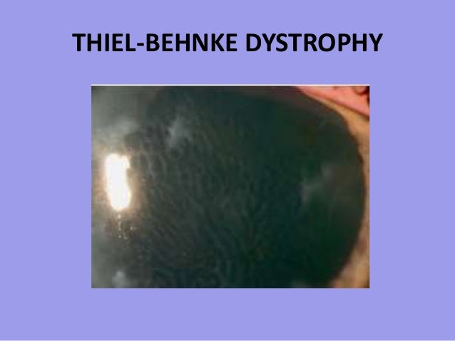 Thiel Behnke Corneal Dystrophy Cornea Grand Rounds