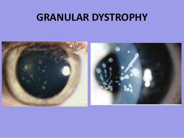 Corneal dystrophies