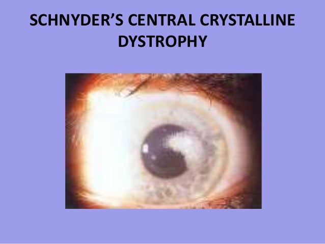 Congenital Hereditary Stromal Dystrophy