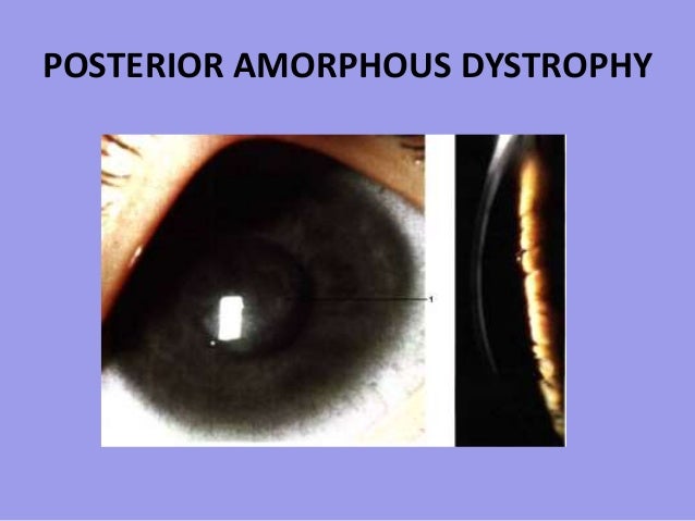 Congenital Hereditary Stromal Dystrophy