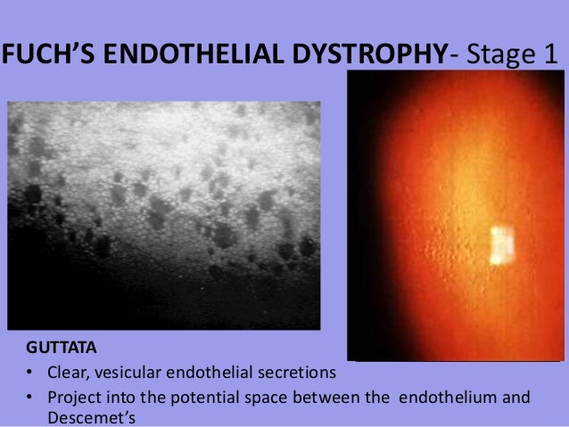Corneal dystrophies