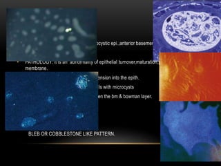 Corneal dystrophies | PPT