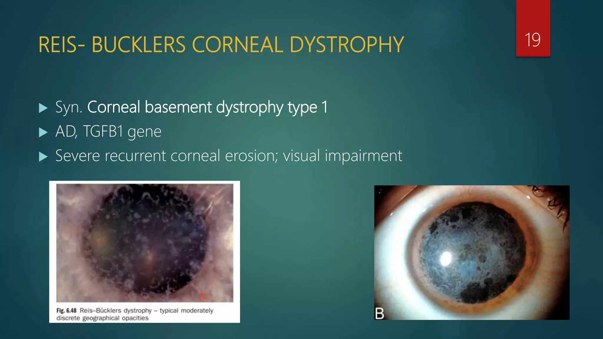 Corneal dystrophies | PPTX