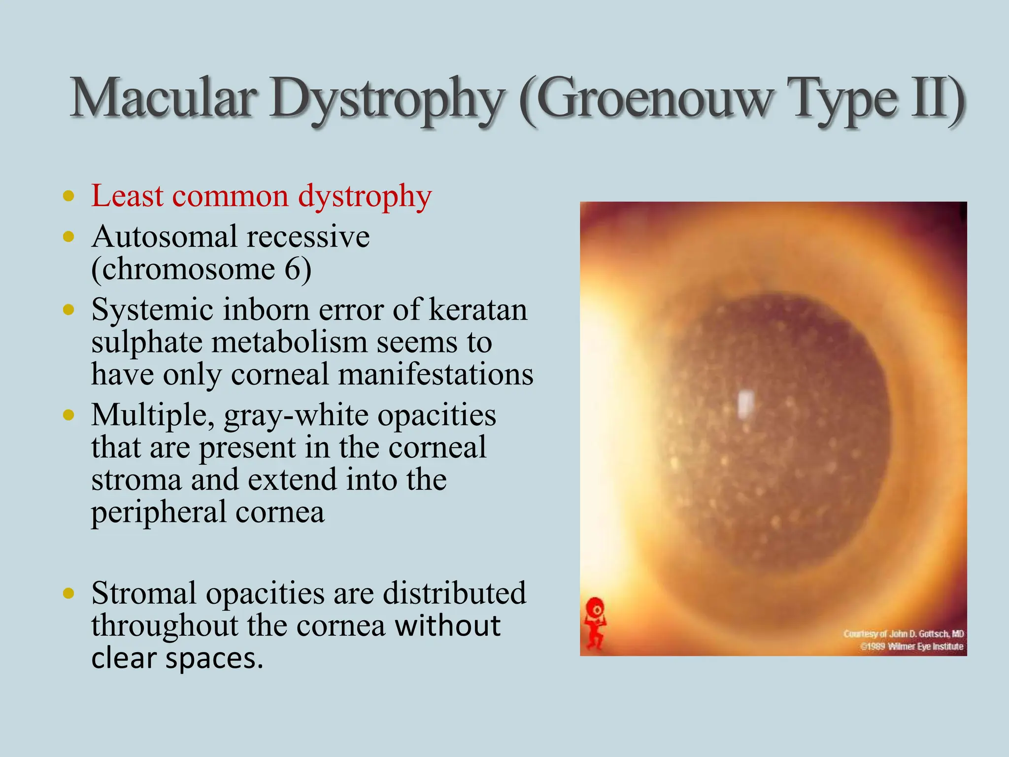CORNEAL DYSTROPHIES PRESENTATION IN OPTOMETRIST PERSPECTIVE | PPTX