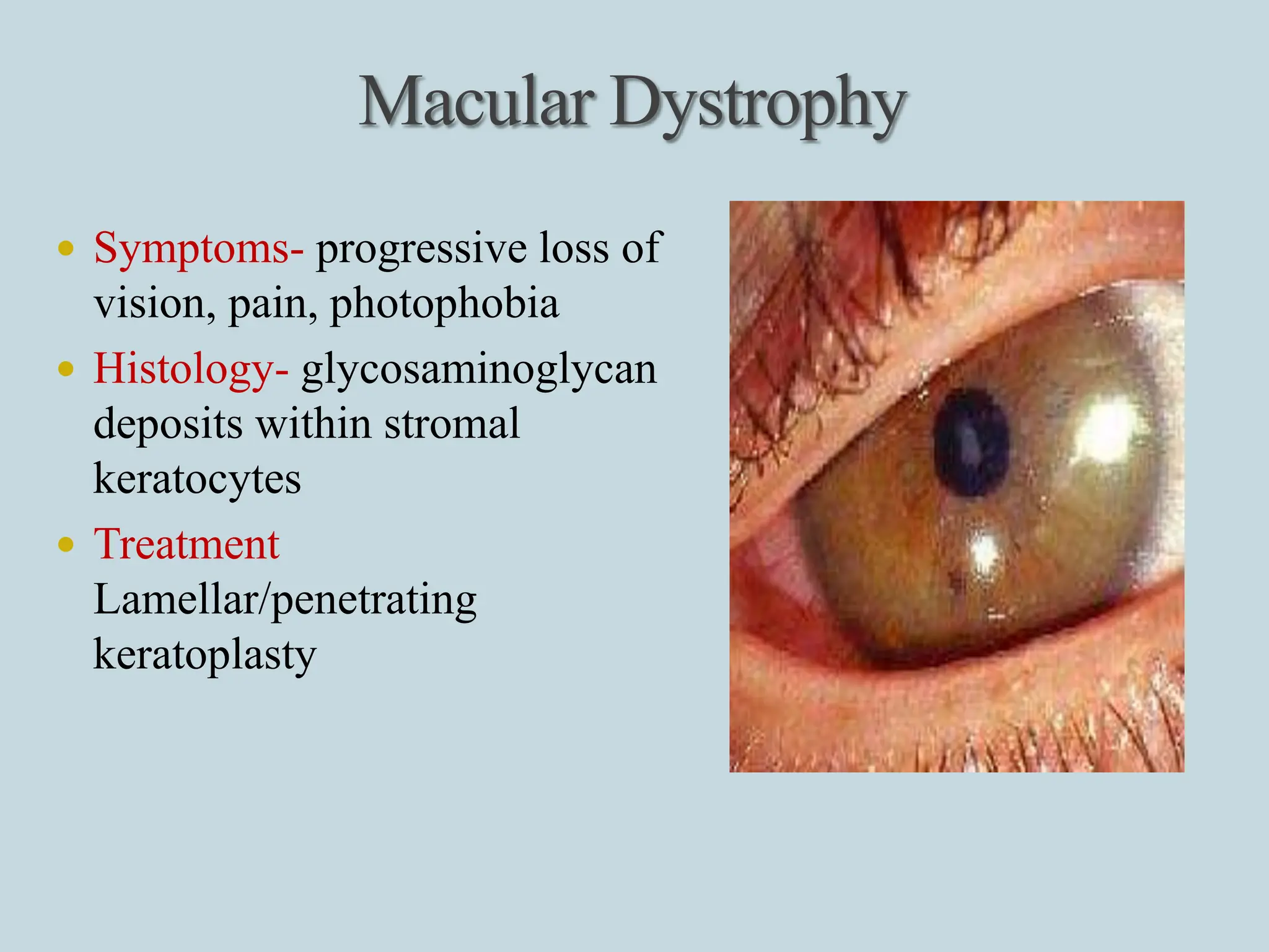 CORNEAL DYSTROPHIES PRESENTATION IN OPTOMETRIST PERSPECTIVE | PPTX