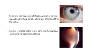 corneal dystrophies. diseases of cornea. | PPT