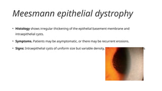 corneal dystrophies. diseases of cornea. | PPT