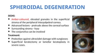 CORNEAL DYSTROPHIES AND DEGENERATIONS w IC3D classification.pptx