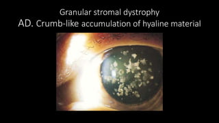 Corneal_dystrophies_&_misc.pptx
