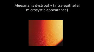 Corneal_dystrophies_&_misc.pptx | Eye and Vision Conditions | Diseases ...