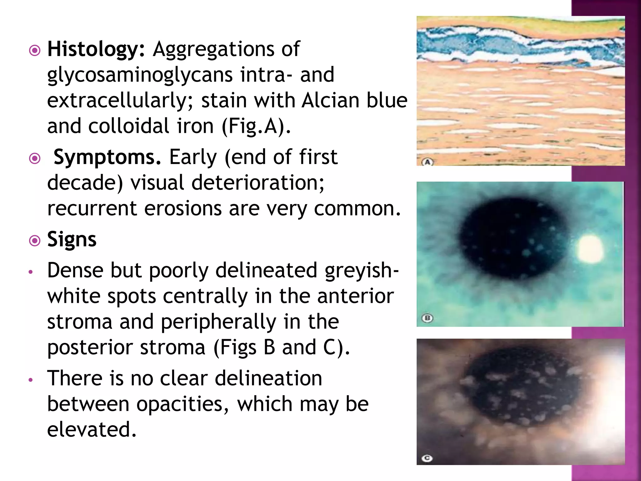 Corneal dystrophies | PPTX