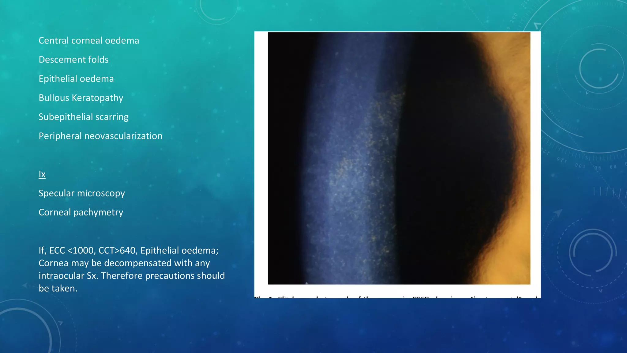 Corneal dystrophy | PPT