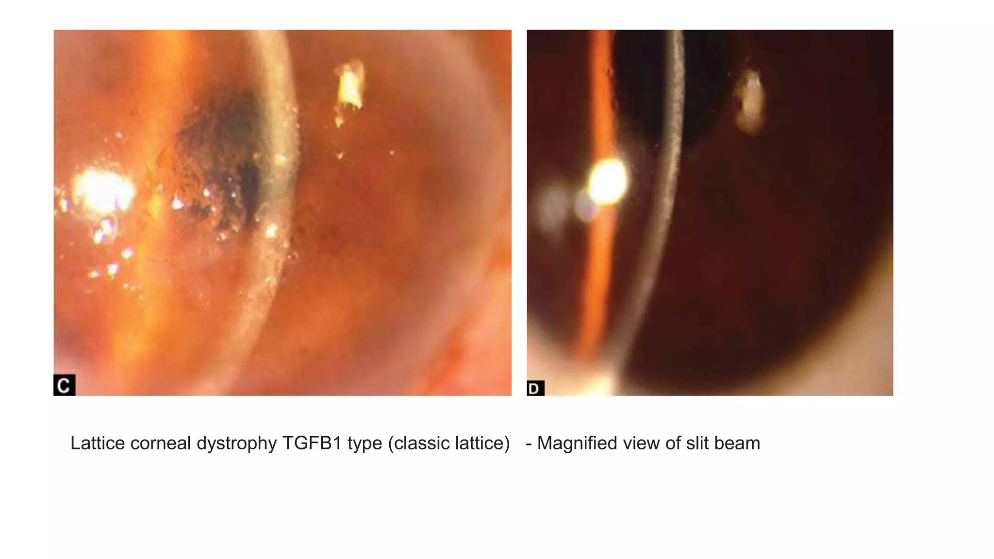 CORNEAL DYSTROPHY.pptx