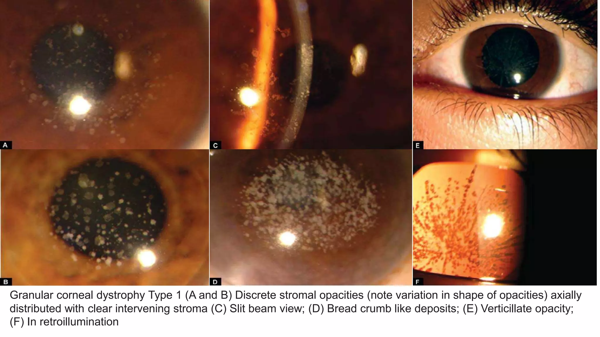 CORNEAL DYSTROPHY.pptx