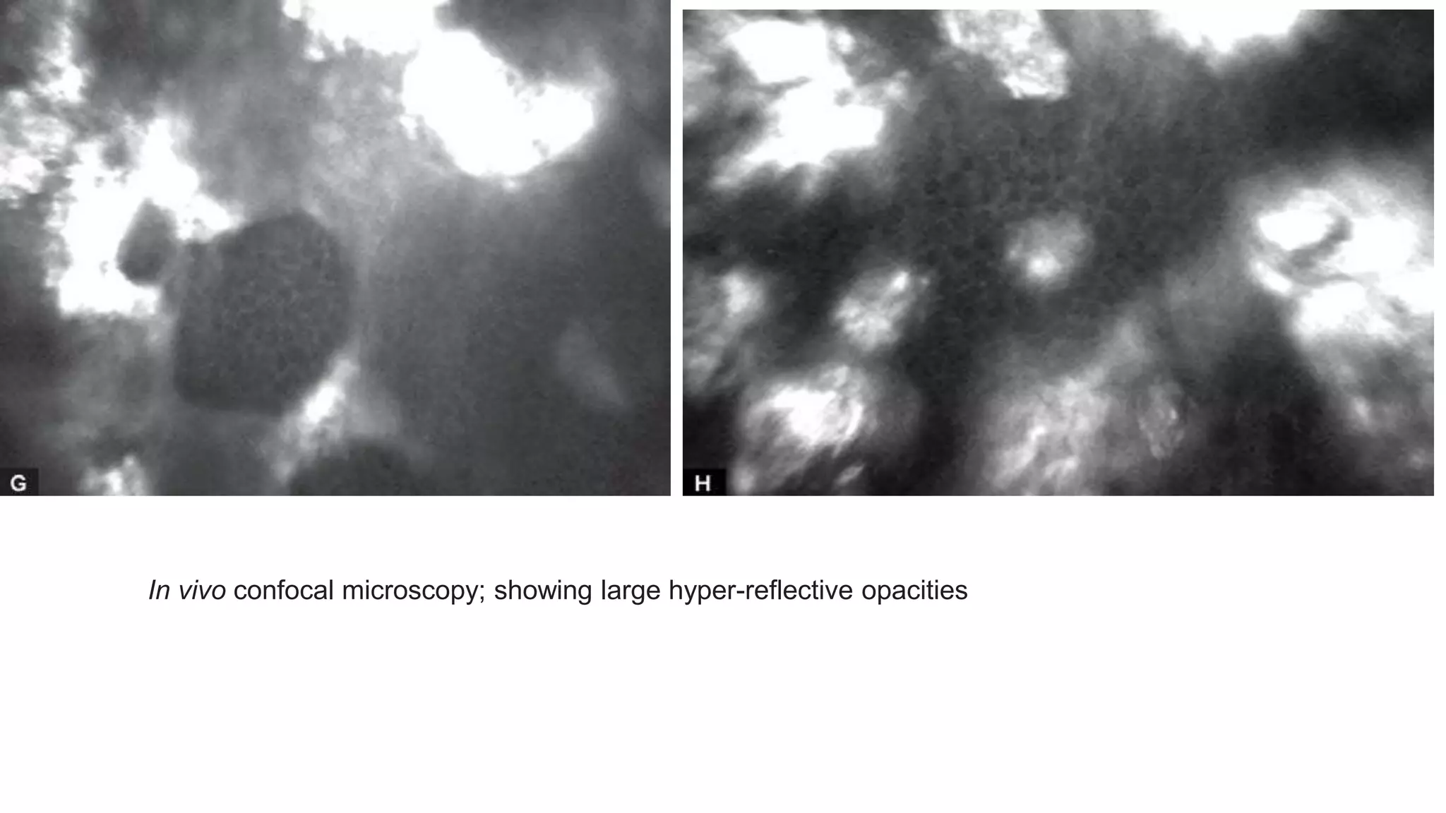 CORNEAL DYSTROPHY.pptx