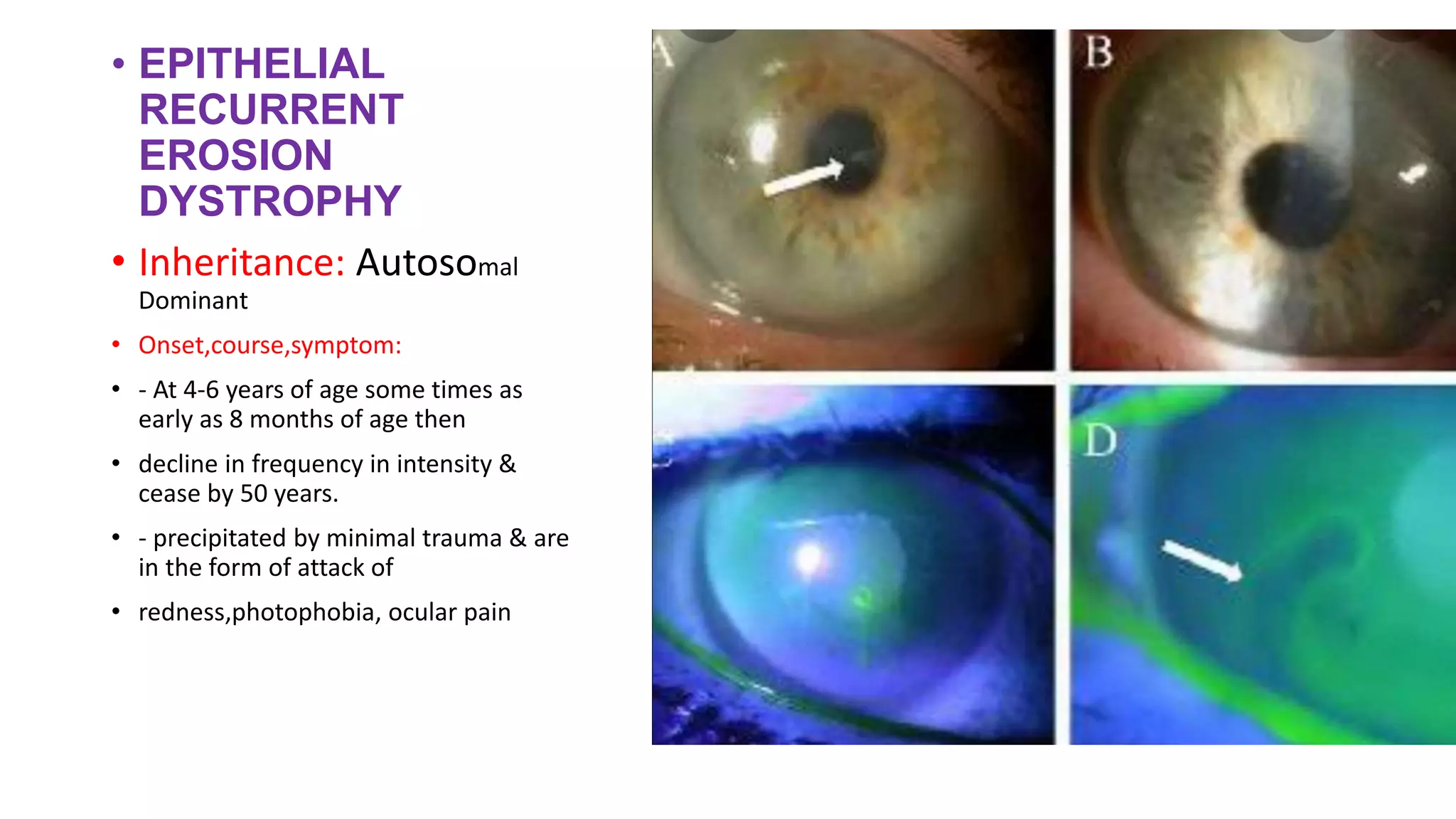 CORNEAL DYSTROPHY.pptx