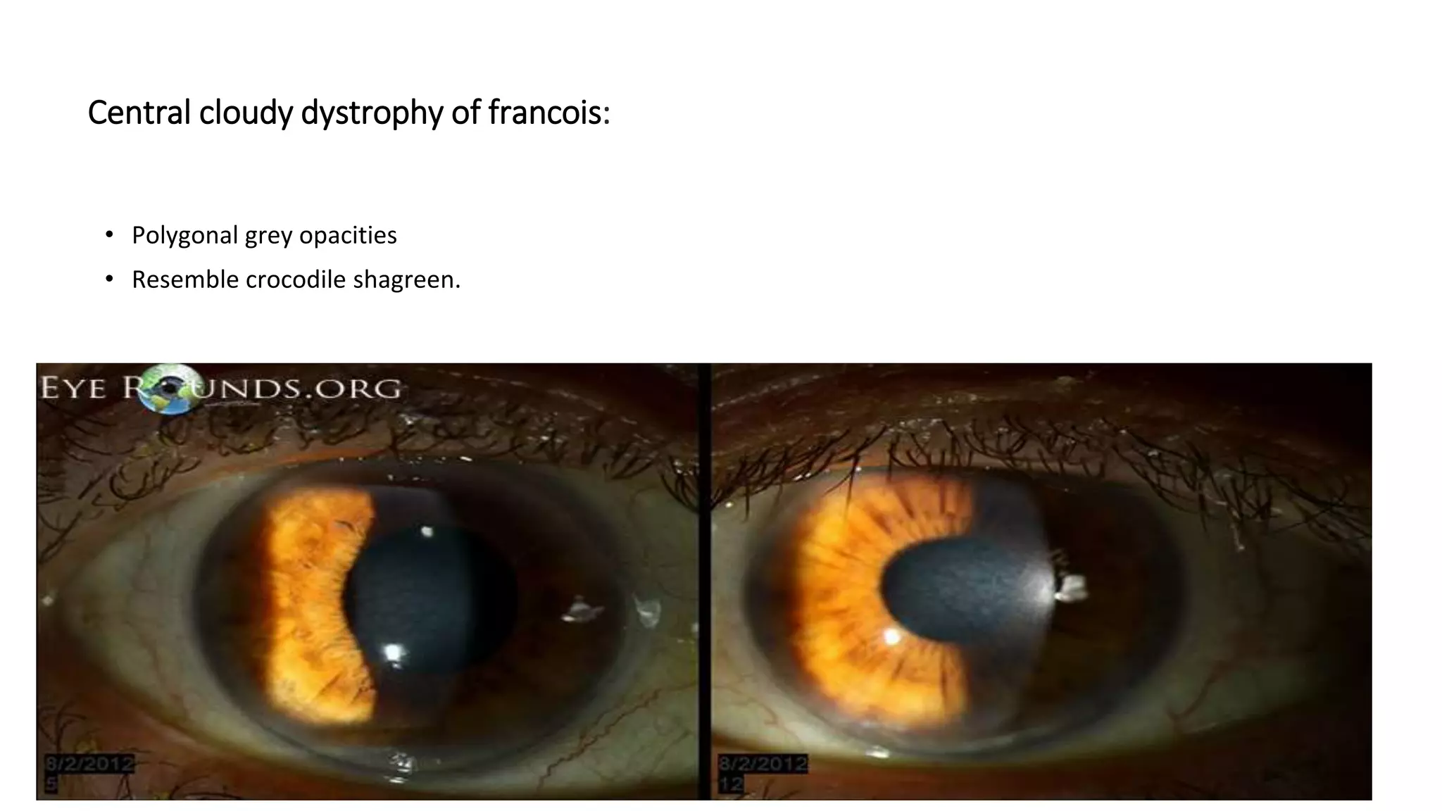 Corneal Dystrophy | PPTX
