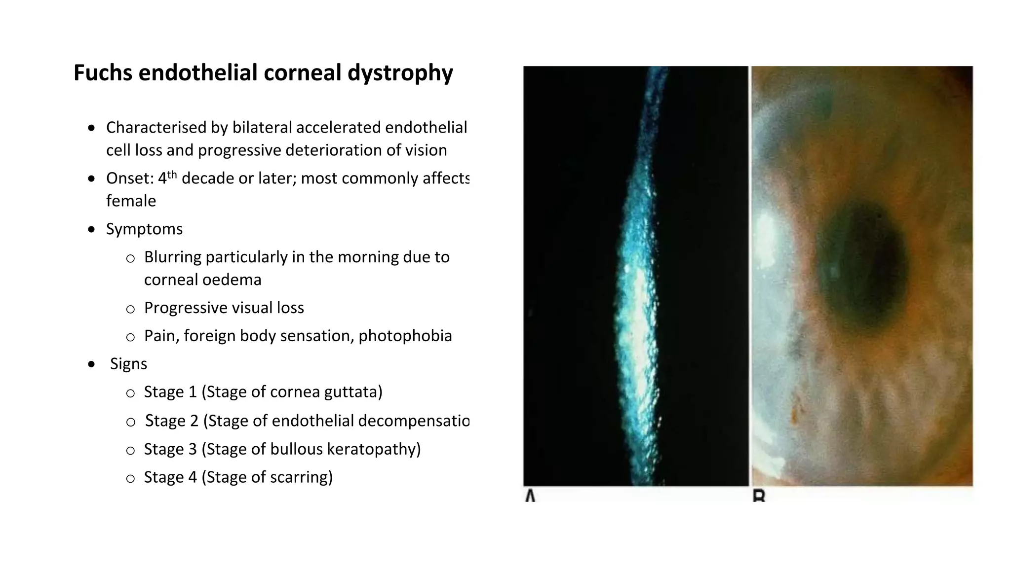 Corneal Dystrophy | PPTX