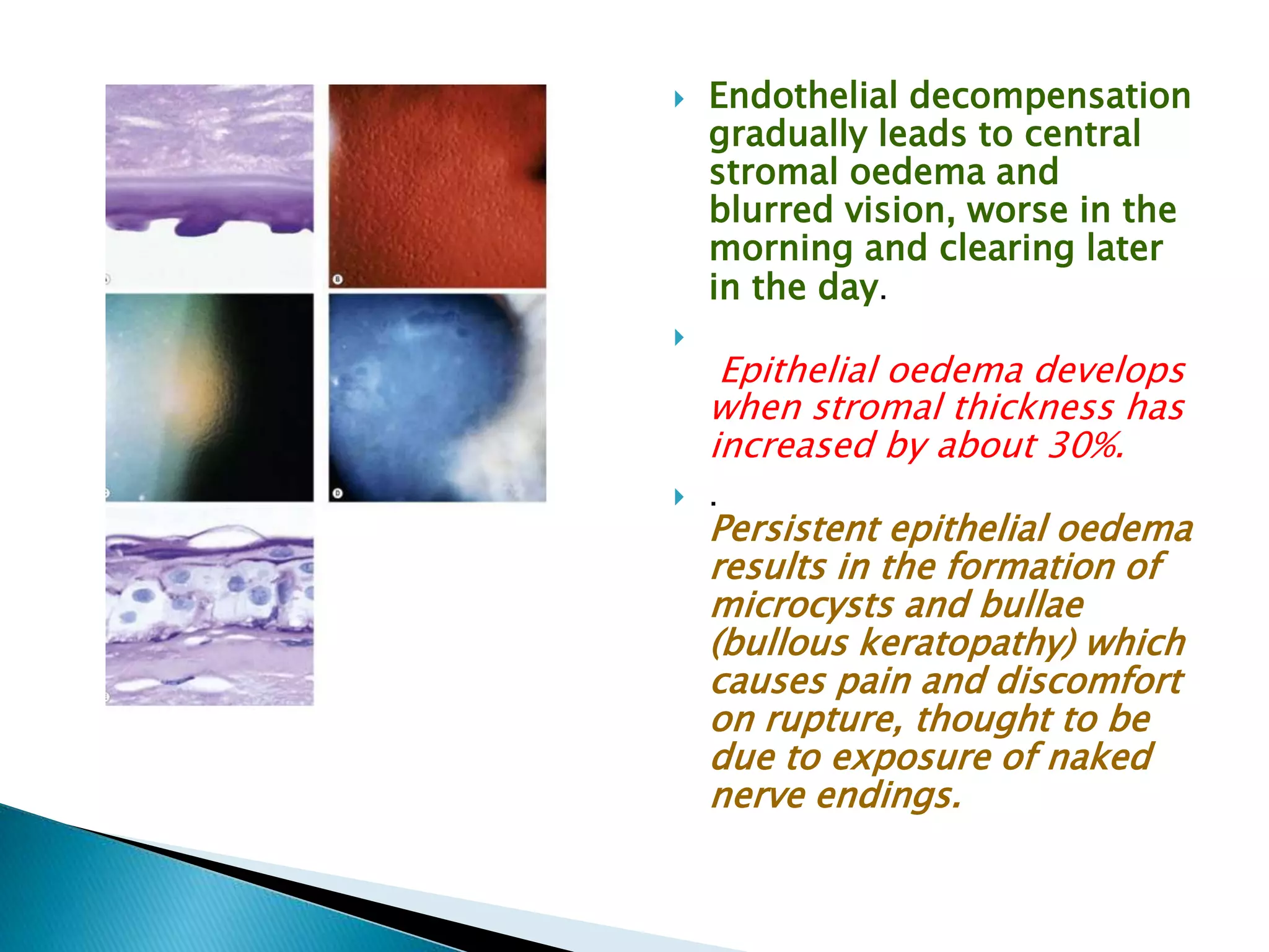 corneal dystrophy.pptx