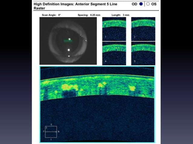 CASE PRESENTATION:Corneal stromal dystrophy | PPTX | Eye and Vision ...